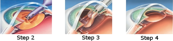 Myopia or Nearsightedness | Moretsky Cassidy Vision Correction Arizona